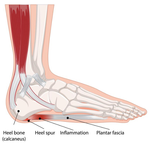Bone Spurs In Foot Symptoms